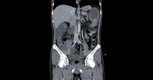 Tomografía computarizada de tórax y abdomen con contraste inyectable ...