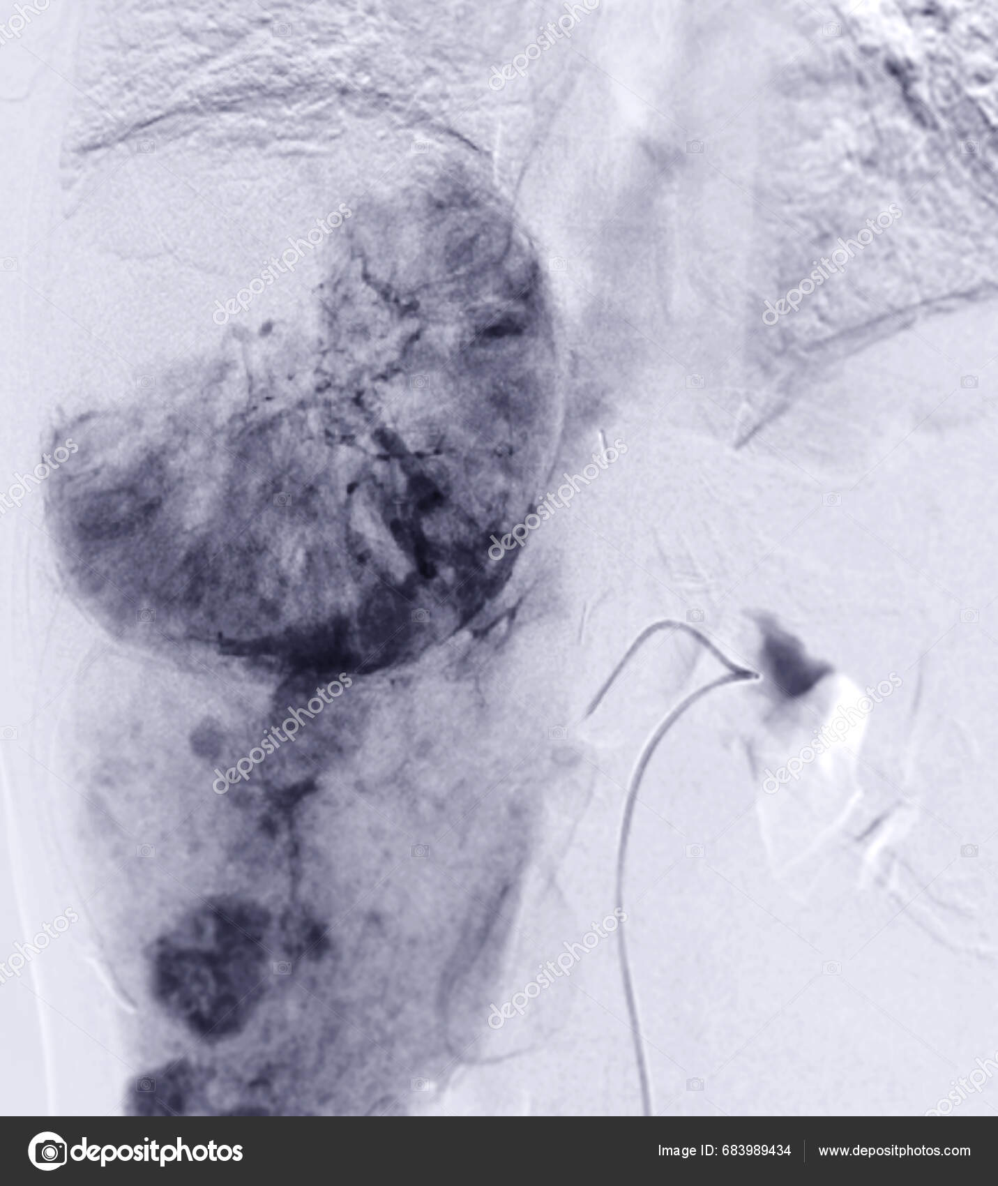 Transarterial Chemoembolization Tace Medical Procedure Used Treatment ...