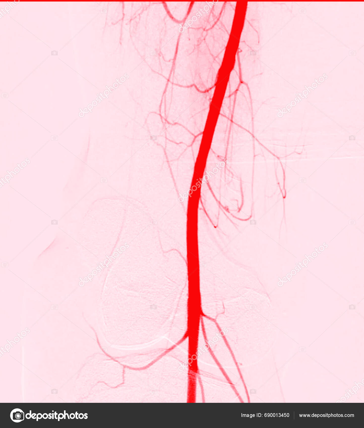 Femoral Angiogram Medical Procedure Used Visualize Blood Vessels Groin ...