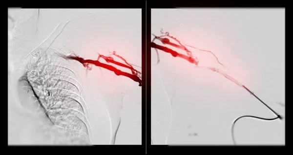 Femoral Angiogram Medical Procedure Used Visualize Blood Vessels Groin ...