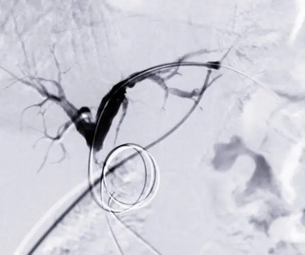 El drenaje biliar transhepático percutáneo (PTBD) es un procedimiento ...