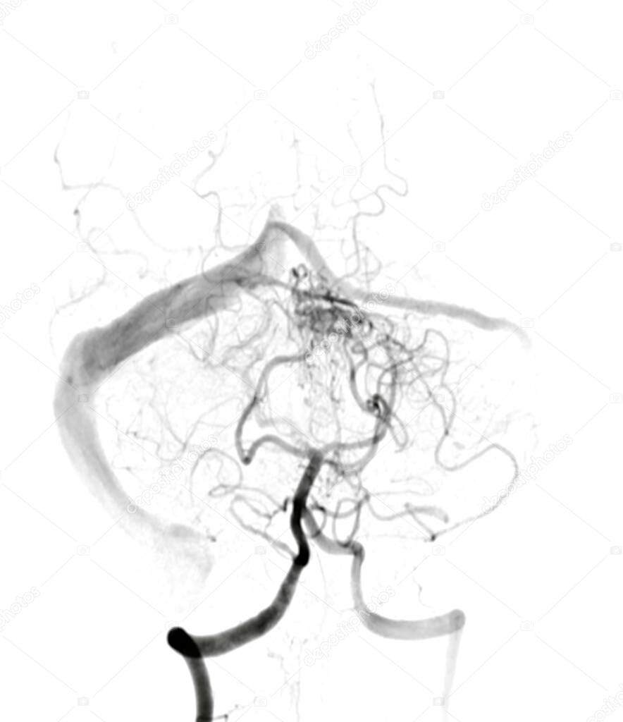 Un angiograma cerebral es un procedimiento médico por imágenes que se ...