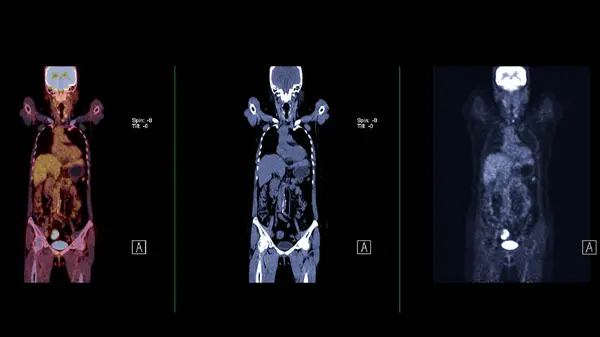 La PET-TC es una visualización diagnóstica que combina la tomografía por emisión de positrones ...