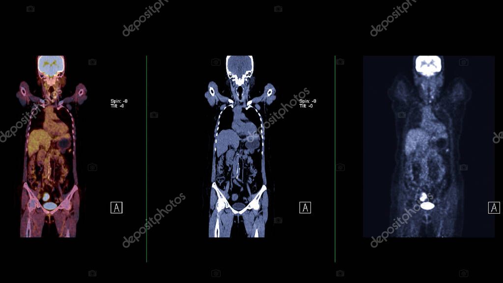 La PET-TC es una visualización diagnóstica que combina la tomografía ...
