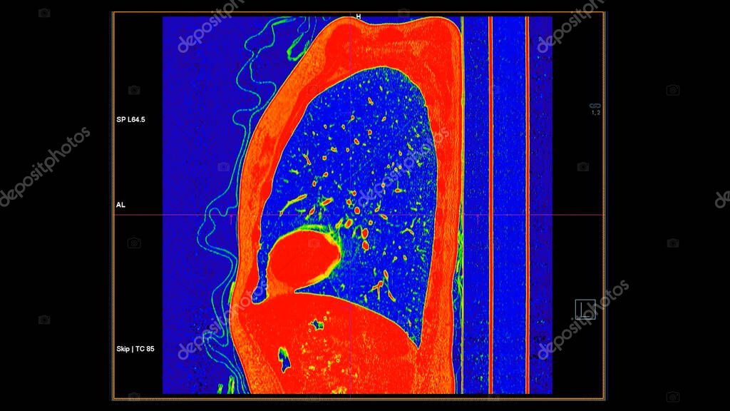 Tomografía computarizada de la vista sagital torácica en modo de color ...