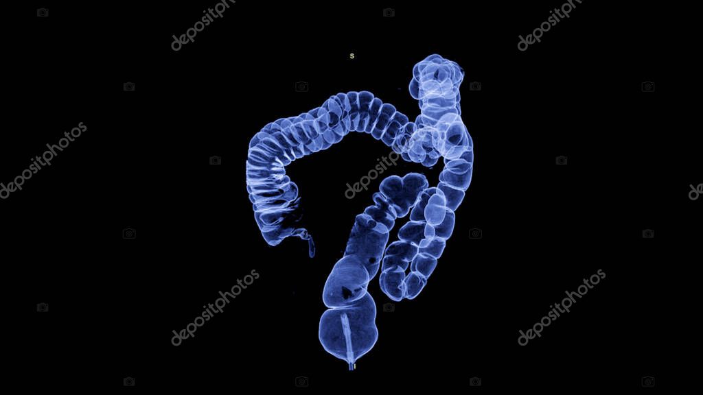 Colonografía por TC, Esta técnica de imagen se utiliza a menudo para el ...