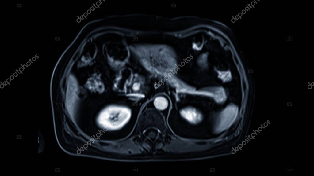 La RMN de la vista axial del abdomen superior es una técnica de imagen ...