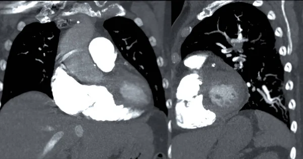 Una arteria pulmonar CTA revela una visión detallada de los vasos ...