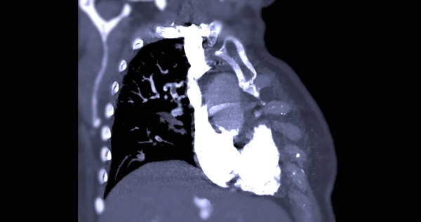 Una arteria pulmonar CTA revela una visión detallada de los vasos ...