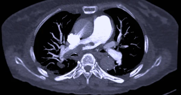 Una arteria pulmonar CTA revela una visión detallada de los vasos ...