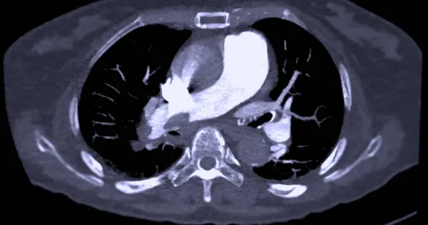 Una arteria pulmonar CTA revela una visión detallada de los vasos ...