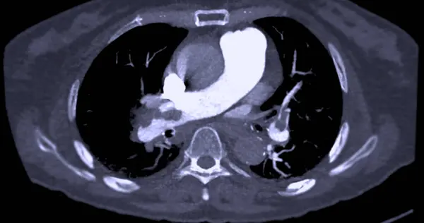 Una arteria pulmonar CTA revela una visión detallada de los vasos ...