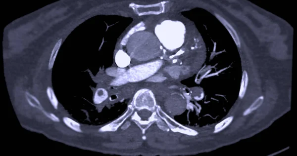 Una arteria pulmonar CTA revela una visión detallada de los vasos ...