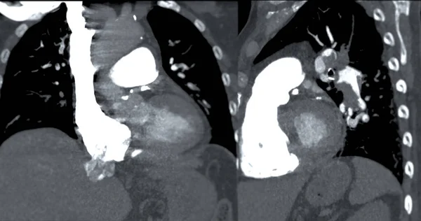 Una arteria pulmonar CTA revela una visión detallada de los vasos ...