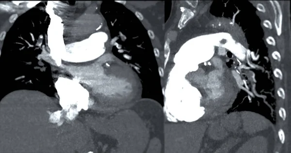 Una arteria pulmonar CTA revela una visión detallada de los vasos ...