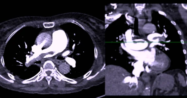Una arteria pulmonar CTA revela una visión detallada de los vasos ...