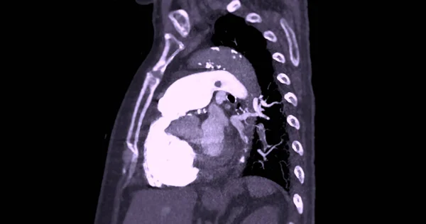 Una arteria pulmonar CTA revela una visión detallada de los vasos ...
