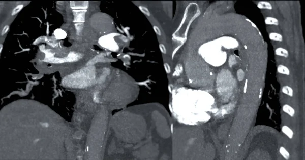 Una arteria pulmonar CTA revela una visión detallada de los vasos ...