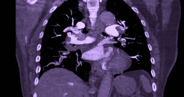 Una arteria pulmonar CTA revela una visión detallada de los vasos ...