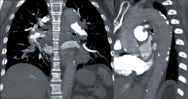 Una arteria pulmonar CTA revela una visión detallada de los vasos ...
