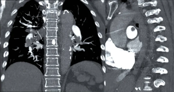 Una arteria pulmonar CTA revela una visión detallada de los vasos ...
