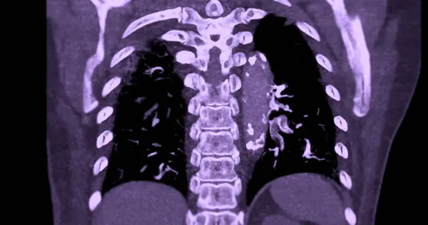 Una arteria pulmonar CTA revela una visión detallada de los vasos ...