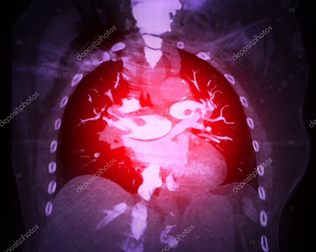 Una arteria pulmonar CTA revela una visión detallada de los vasos ...