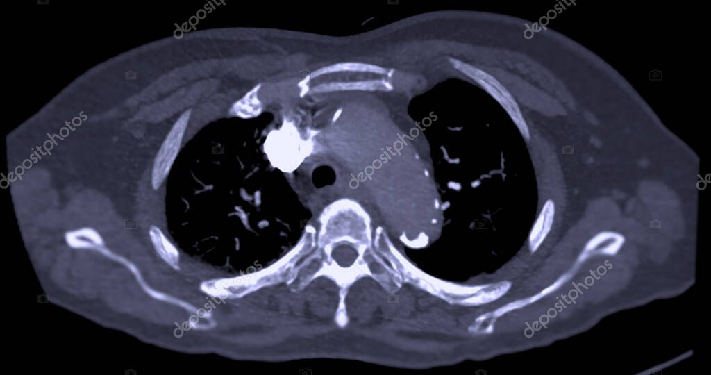 Una arteria pulmonar CTA revela una visión detallada de los vasos ...