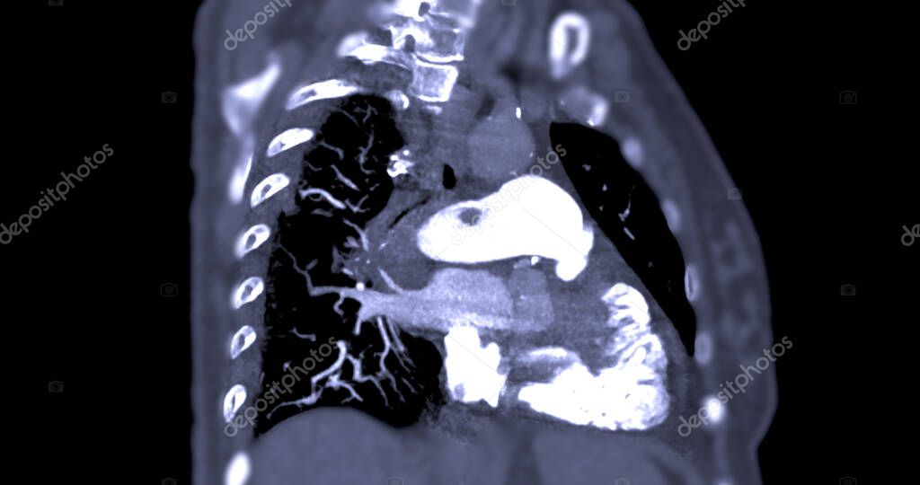 Una arteria pulmonar CTA revela una visión detallada de los vasos ...