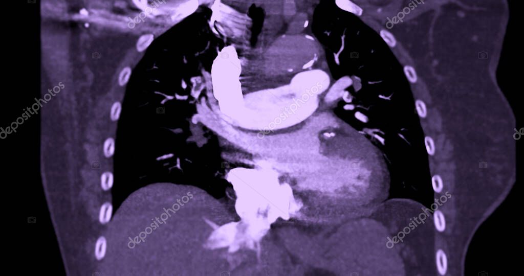 Una arteria pulmonar CTA revela una visión detallada de los vasos ...