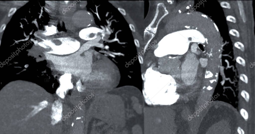 Una arteria pulmonar CTA revela una visión detallada de los vasos ...