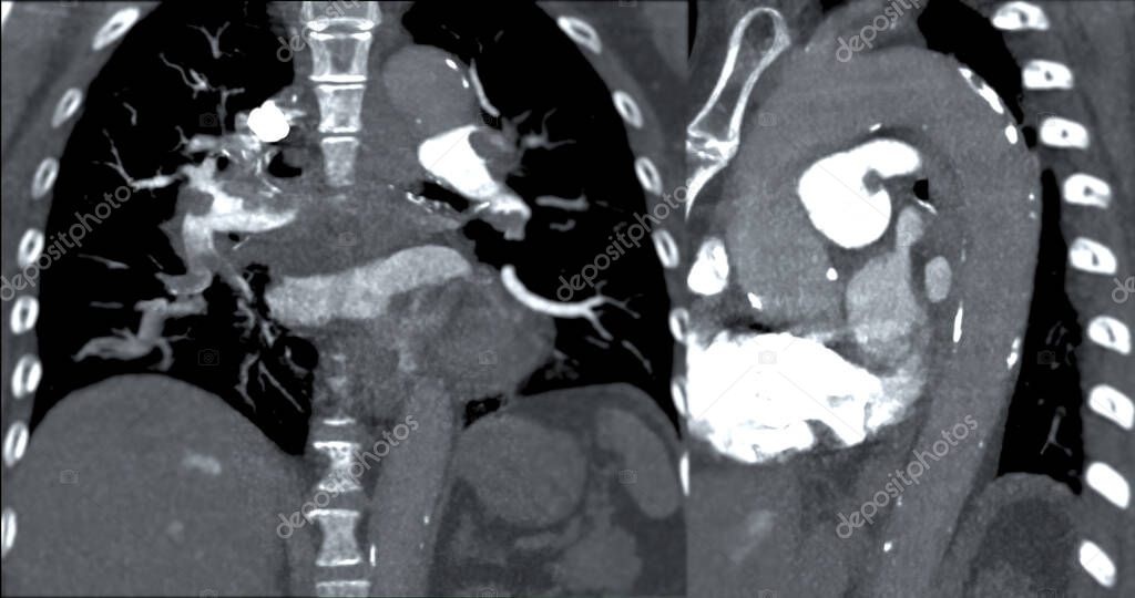 Una arteria pulmonar CTA revela una visión detallada de los vasos ...