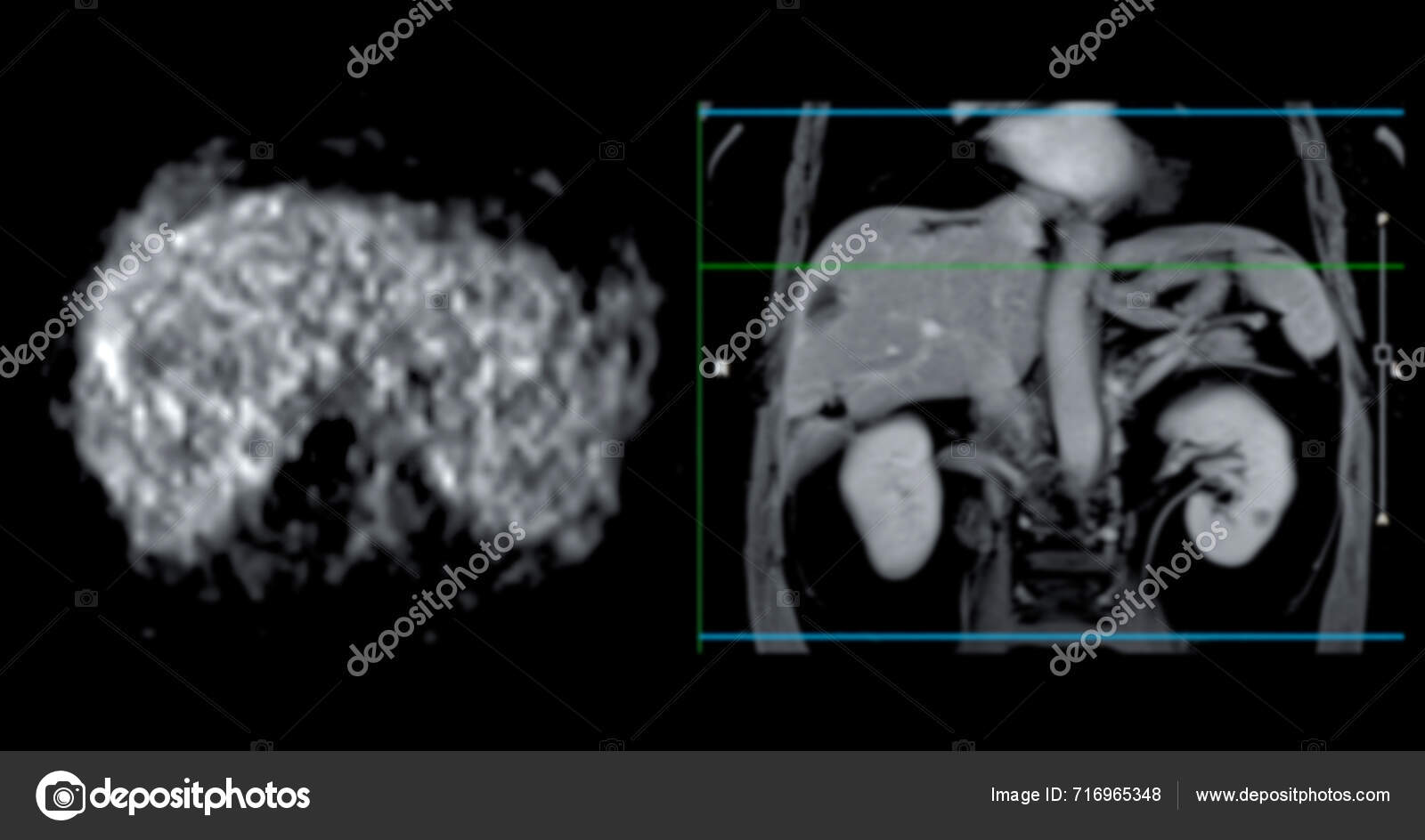 Pet Mri Liver Liver Cancer Provides Precise Imaging Aiding Tumor ...