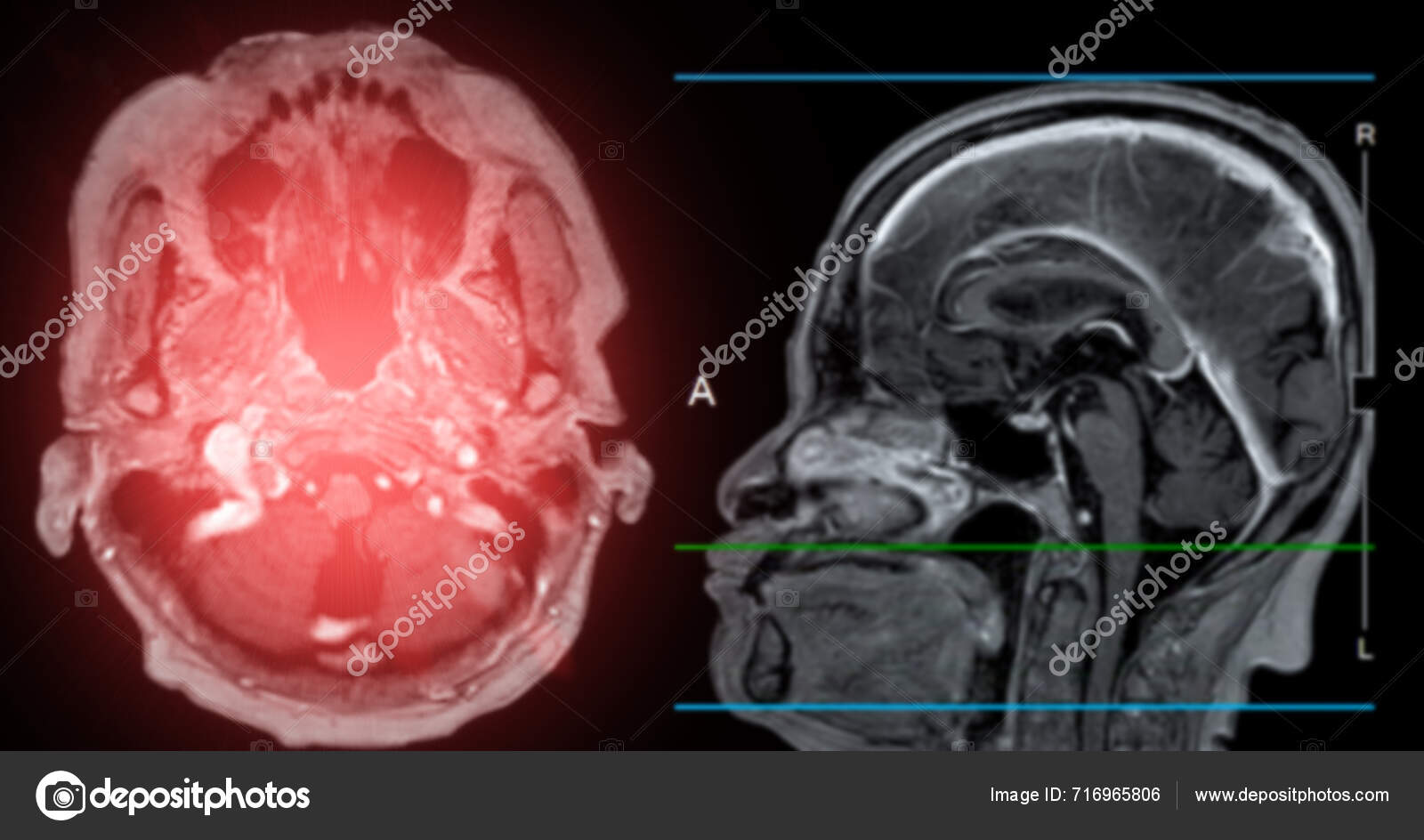 Mri Brain Scan Sagittal Plane Detect Brain Diseases Sush Stroke — Stock ...