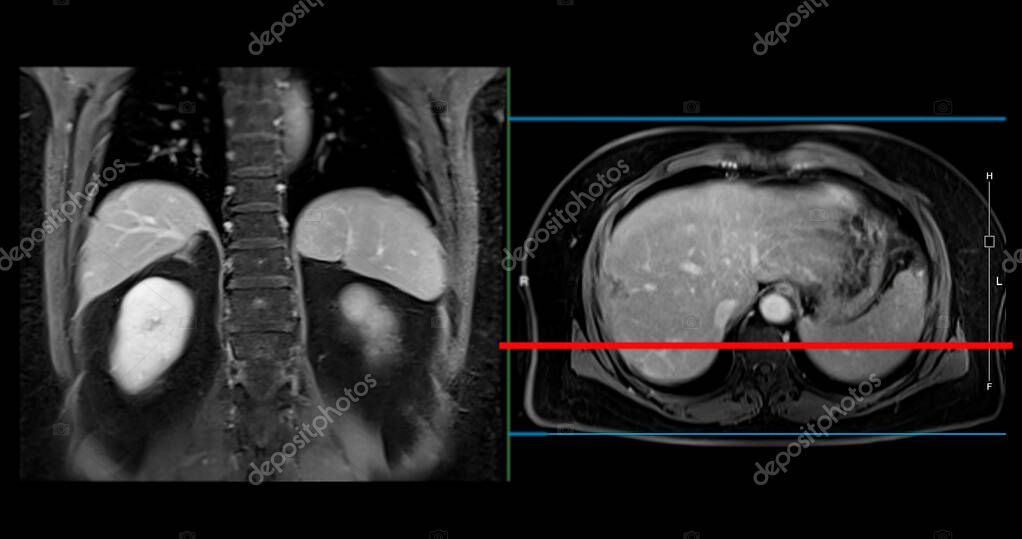 La resonancia magn tica PET del h gado en el c ncer de h gado proporciona im genes precisas ...