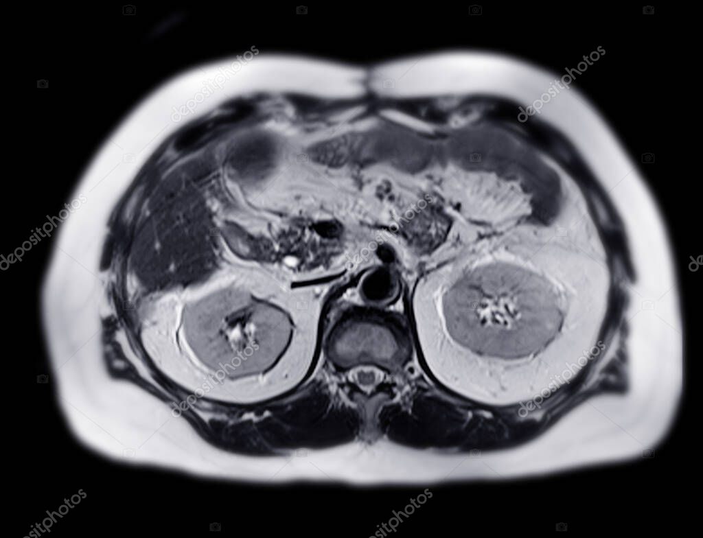La resonancia magnética del abdomen superior es una técnica de imagen ...