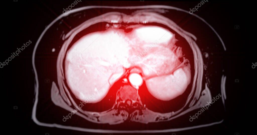 La resonancia magnética del abdomen superior es una técnica de imagen ...