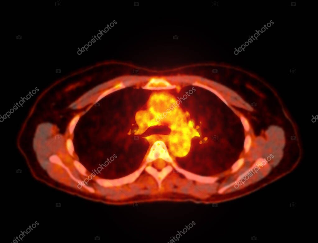 La PET-TC es una visualización diagnóstica que combina la tomografía ...