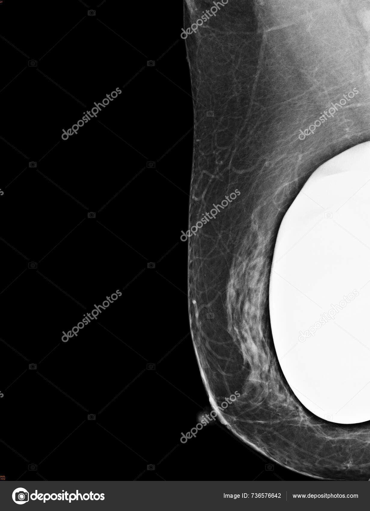 Mammogram Rads Benign Shows Breast Implant Augmentation Visible Signs ...