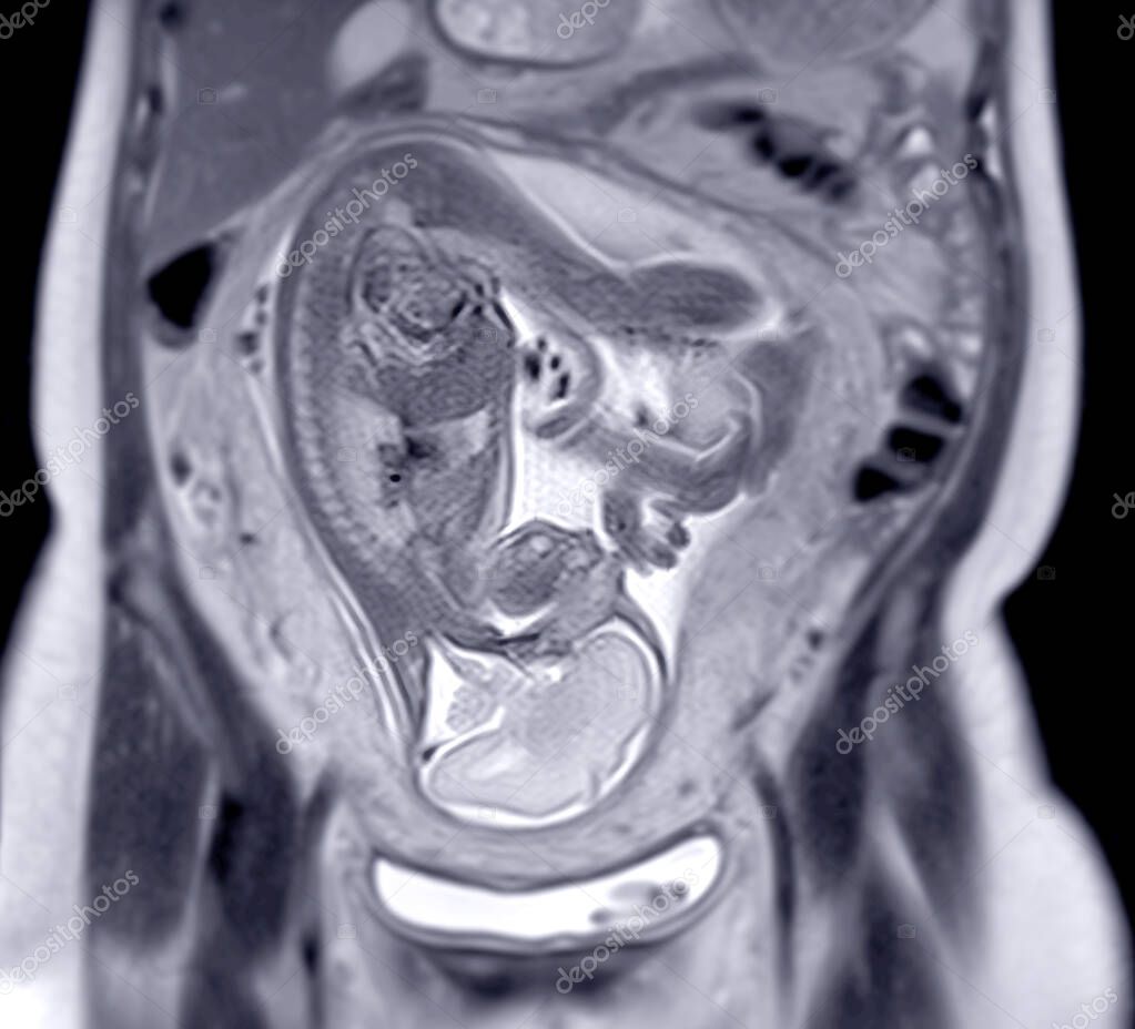 La resonancia magnética durante el embarazo garantiza la evaluación no ...
