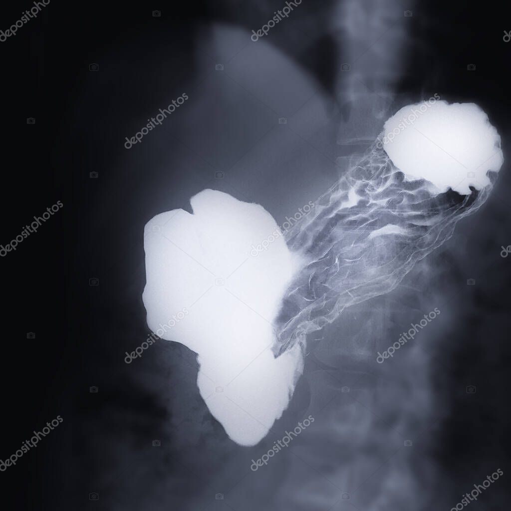 Imagen de rayos X del estómago con contraste de bario, mostrando una ...