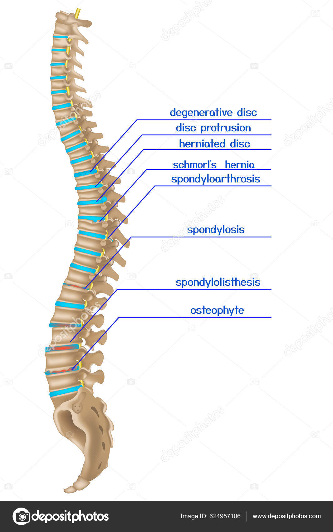 Columna Dañada Infografías Diversas Enfermedades Espalda Ilustración ...
