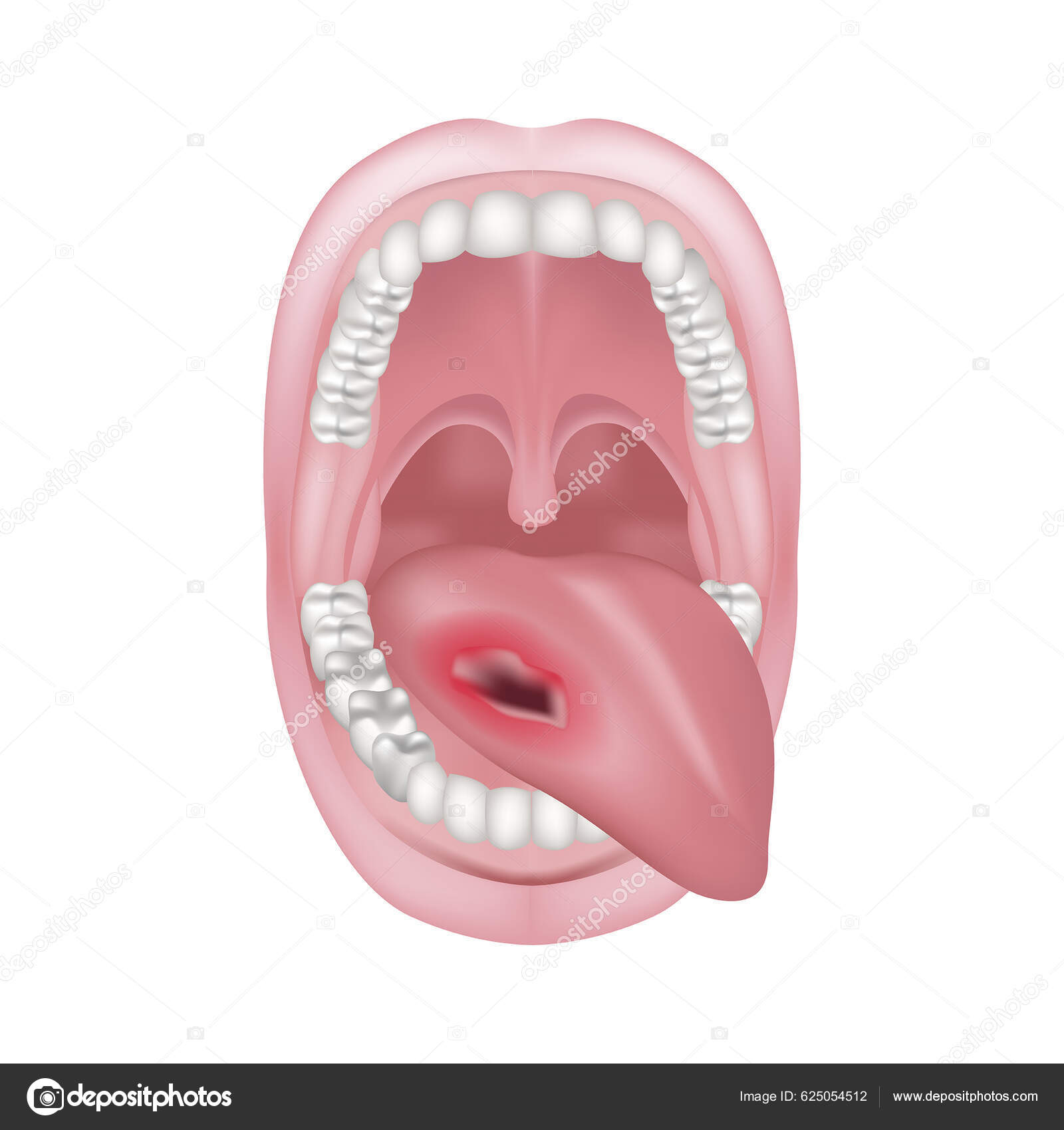 Cancro Língua Cavidade Oral Ferida Está Boca Oncologia Anatomia Maxilar ...