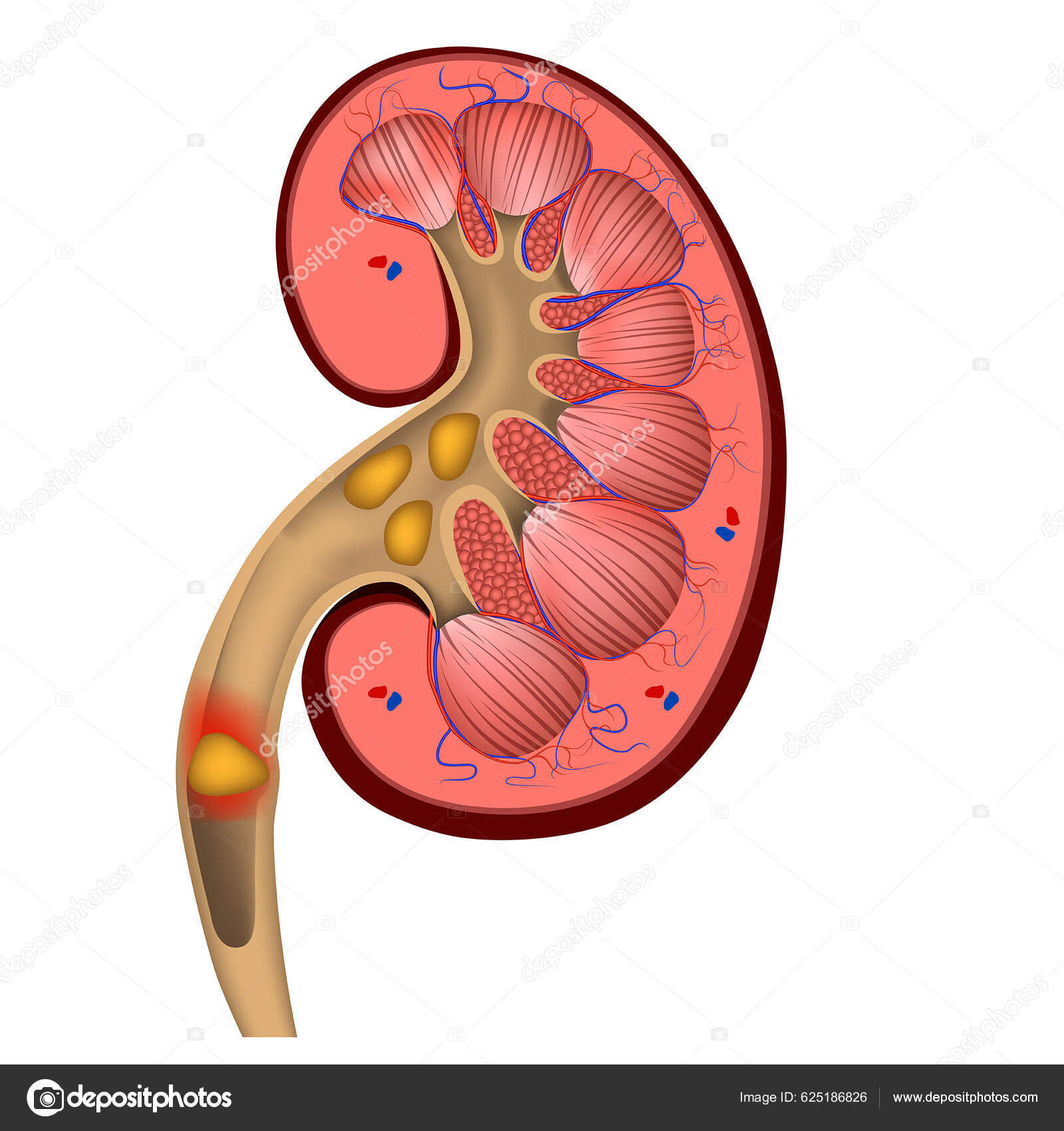 Cólica Renal Formação Pedras Nos Órgãos Rim Humano Ilustração Vetorial ...