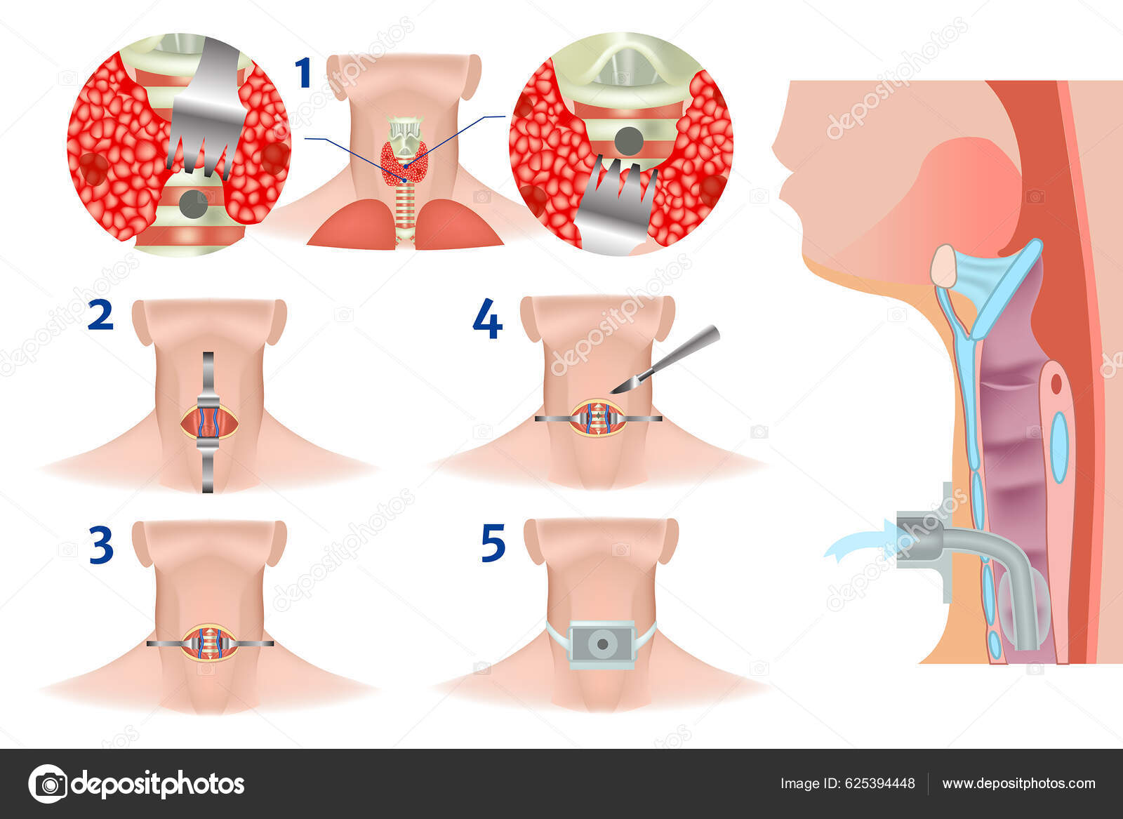 Traqueostomía Superior Inferior Cirugía Traqueal Esquema Ejecución Una ...