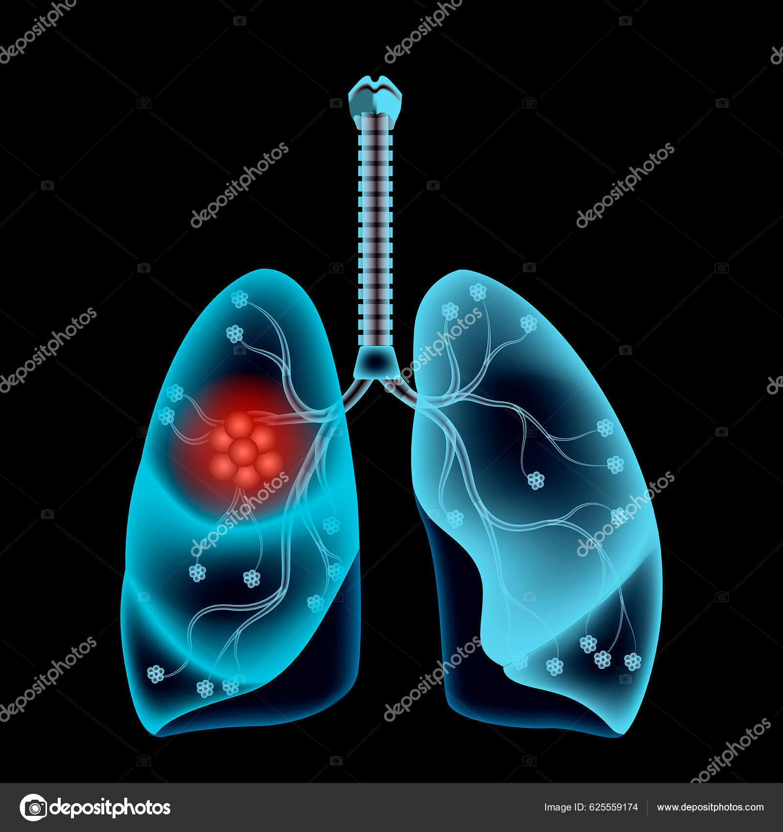 Ray Lungs Swelling Inflammation Cancer Indicated Red Formation Vector ...