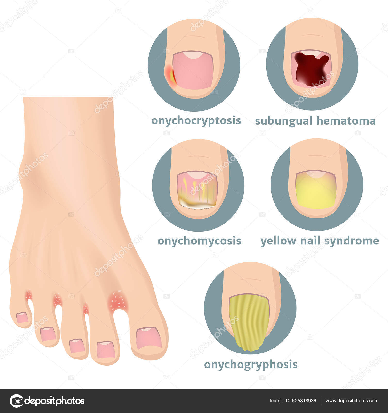 Tipos Daño Las Uñas Los Pies Pie Con Hongo Cartel Vector de stock ...