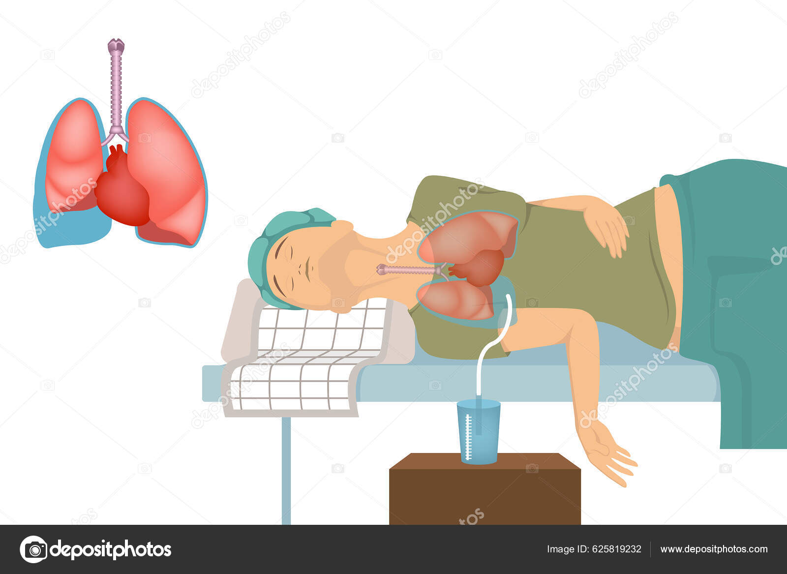 Épanchement Pleural Patient Avec Cathéter Dans Les Poumons Procédure ...
