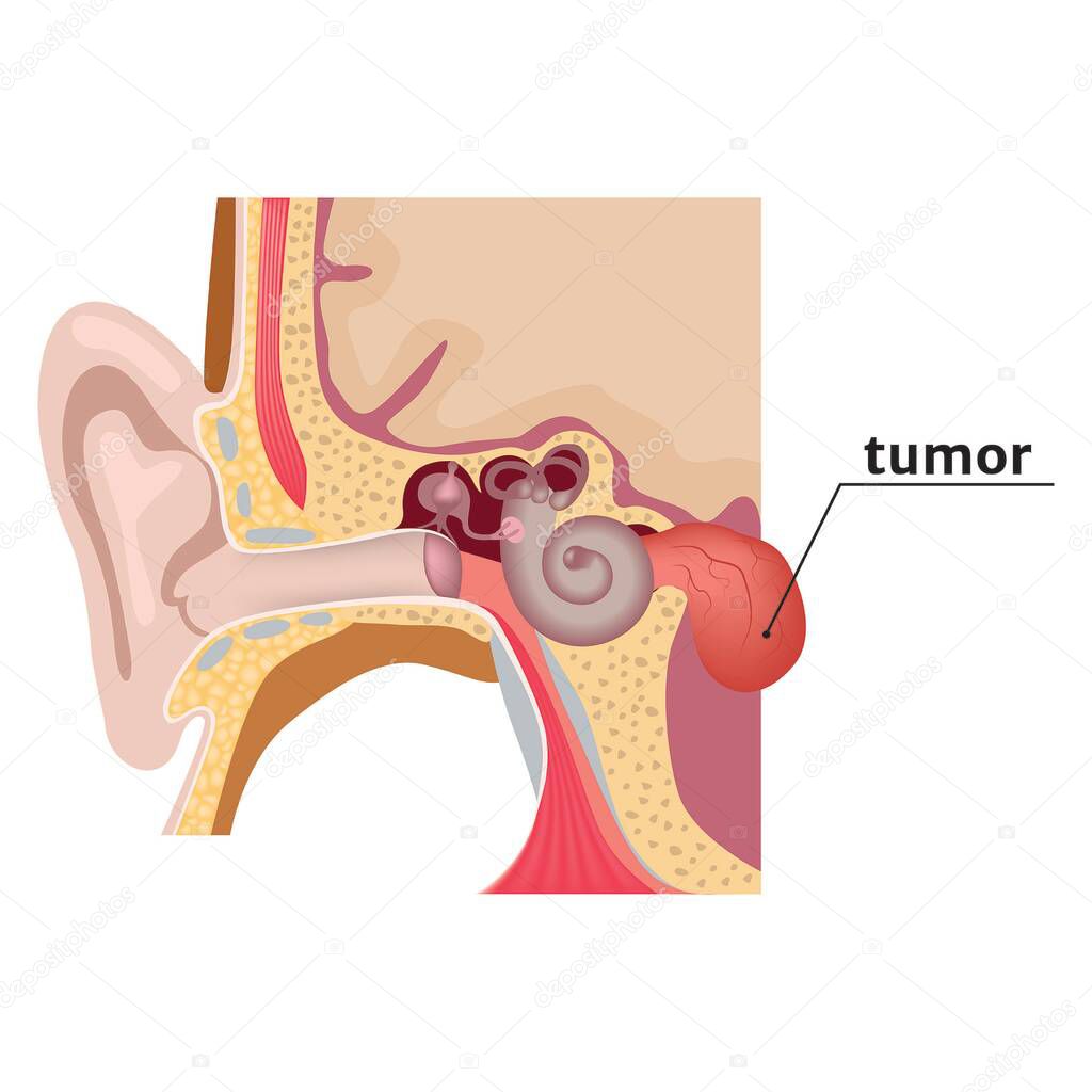 schwannoma vestibular. Diagrama con un tumor en el oído interno ...
