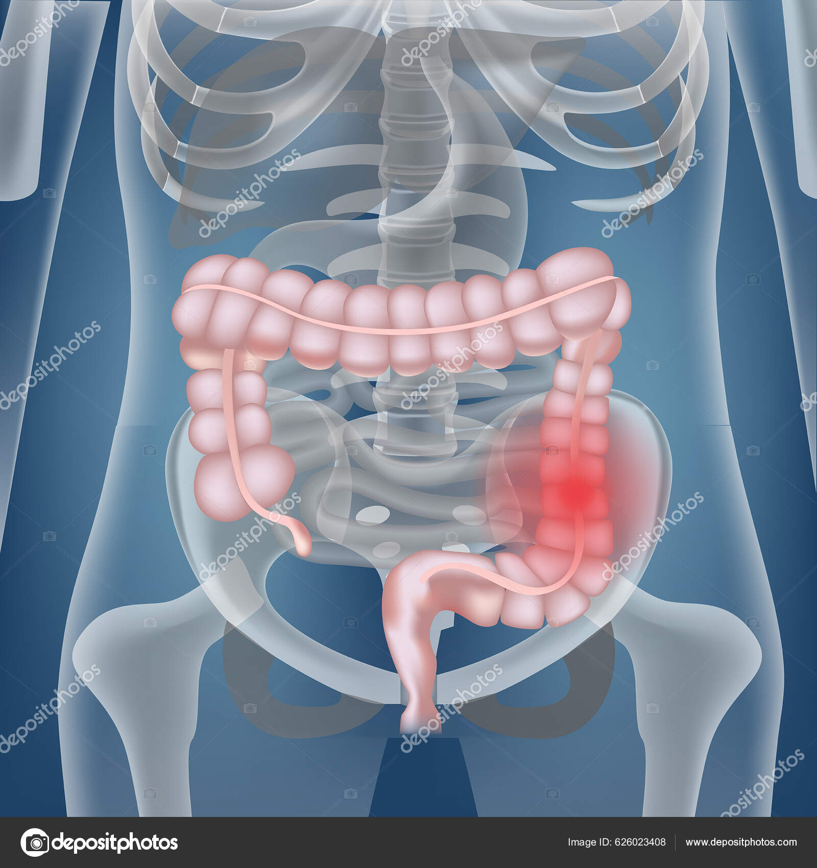 Bowel Cancer Location Internal Organs Background Skeleton Abdominal ...